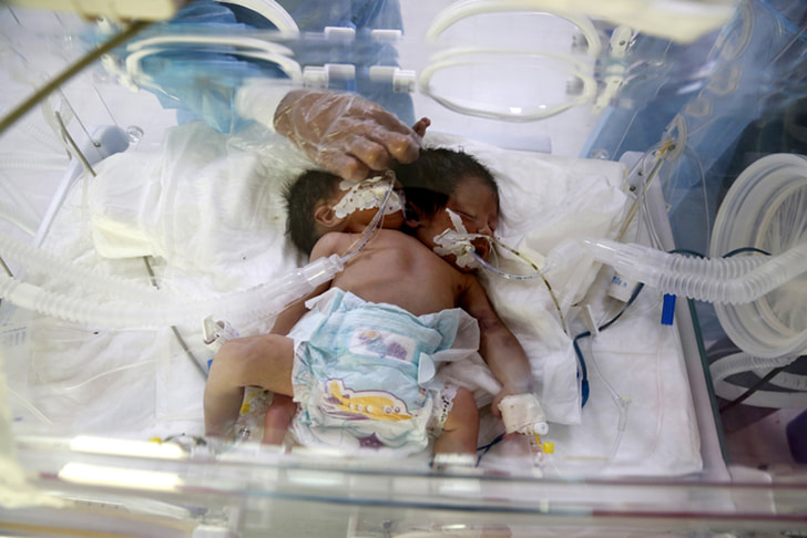 The Hensel Conjoined Twins Who Are Living Proof That Anything Is ...