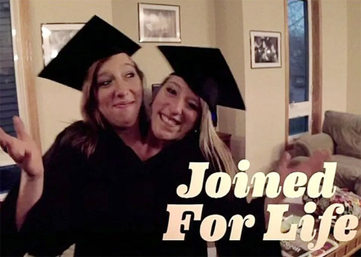 The Hensel Conjoined Twins Who Are Living Proof That Anything Is ...