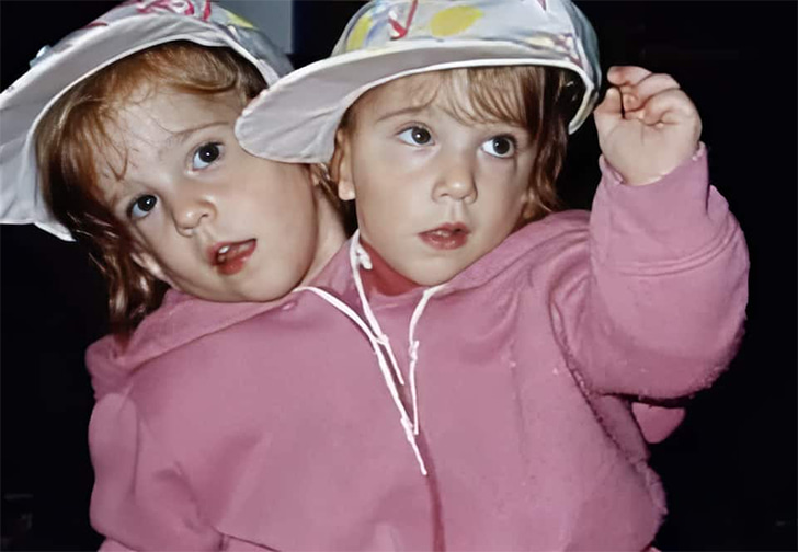 The Hensel Conjoined Twins Who Are Living Proof That Anything Is ...